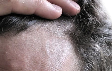 Berg op de hoofdhuid bij volwassenen? Oorzaken, behandeling en shampoo ...